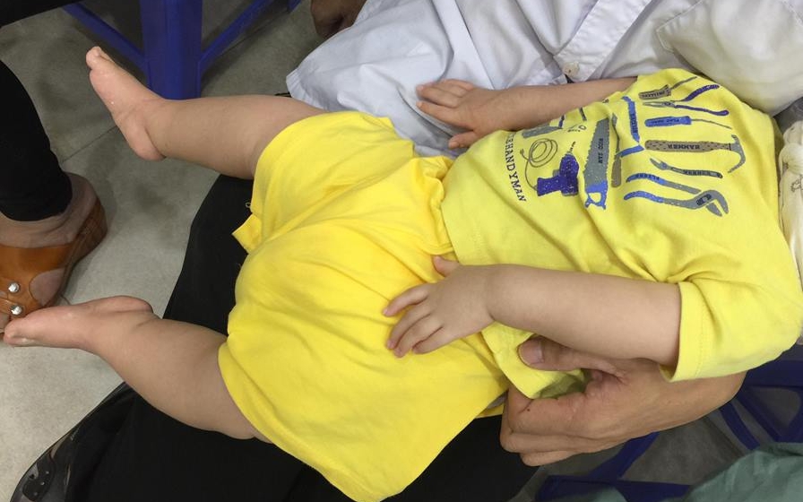 Câu hỏi thường gặp về khoèo chân bẩm sinh - Diễn đàn Y khoa